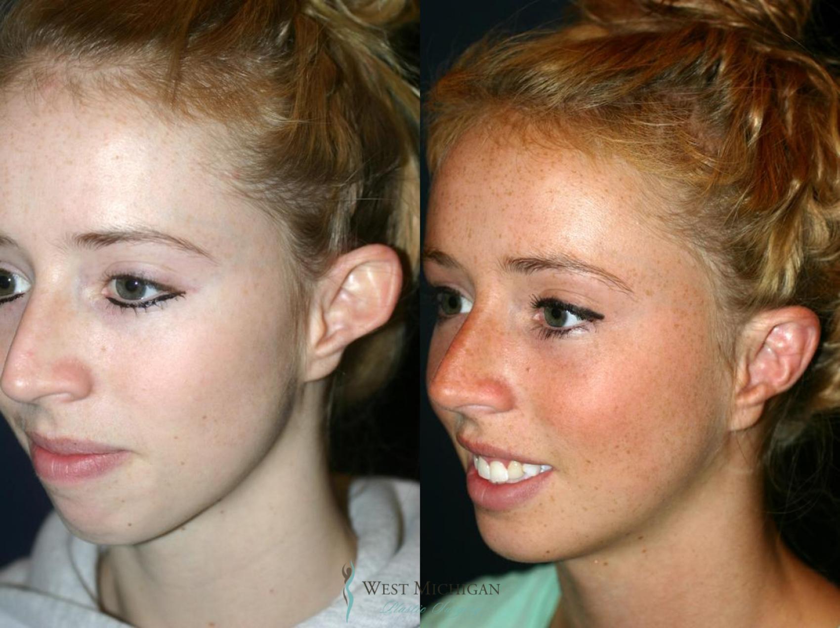 Ear Surgery Before and After Pictures Case 8882 | Kalamazoo & Grand ...