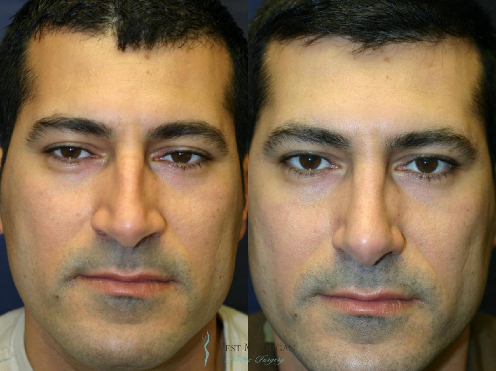 Nose Surgery Before and After Pictures Case 8888 | Kalamazoo & Grand ...