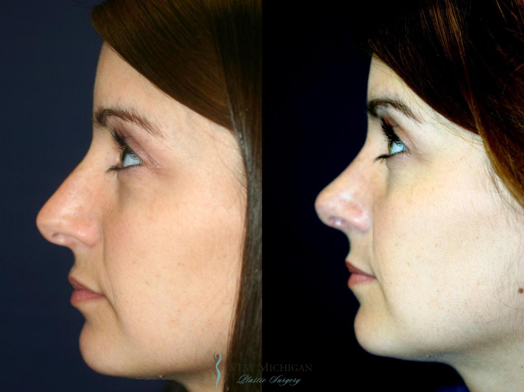 Nose Surgery Before and After Pictures Case 8893 | Kalamazoo & Grand ...